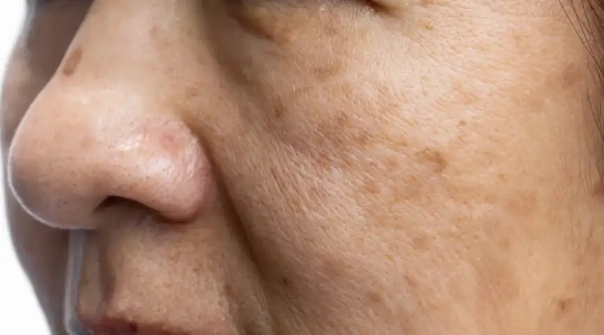 Melasma in Singapore: Causes & Treatment Options