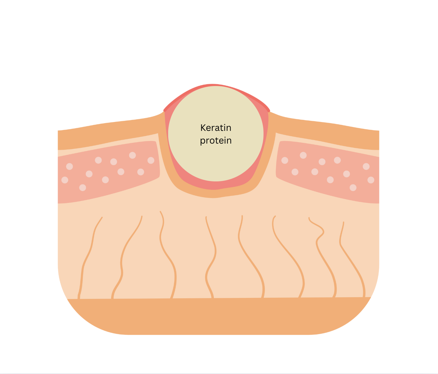 Milia Seed Removal in Singapore Guide