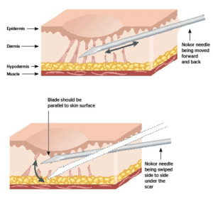 Subcision: Your Guide to Scar Removal & Skin Rejuvenation